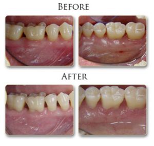 Periodontal Pocket Reduction - Dentist Valdosta, GA | Kilby Cosmetic ...